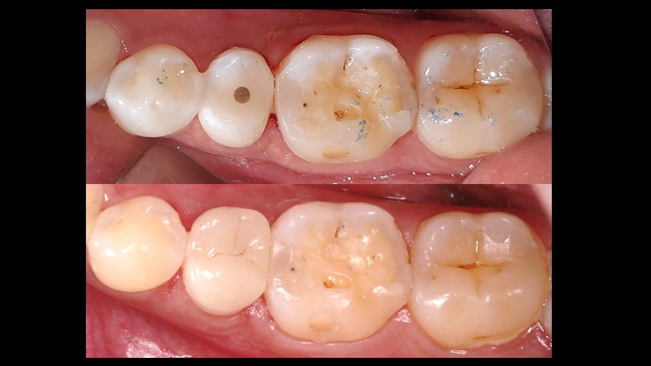 Restoring Smiles with EMax Onlay